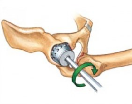 The Anterior Total Hip Walkthrough – What Happens in Surgery