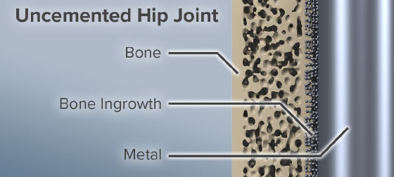 Hip Replacement: The POLARSTEM & R3 Acetabular Cup – A New Design for ...