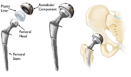 The Anterior Approach to Total Hip Replacement