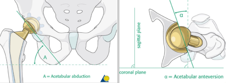 Computer Navigation Total Hip Arthroplasty - The Hip "Xpert"